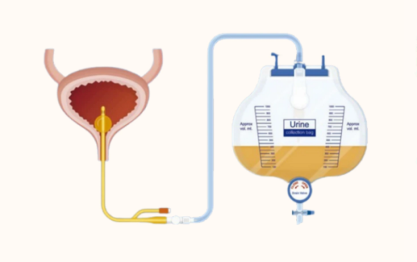Procedimiento para la colocación de sonda vesical. - UNIMAAT